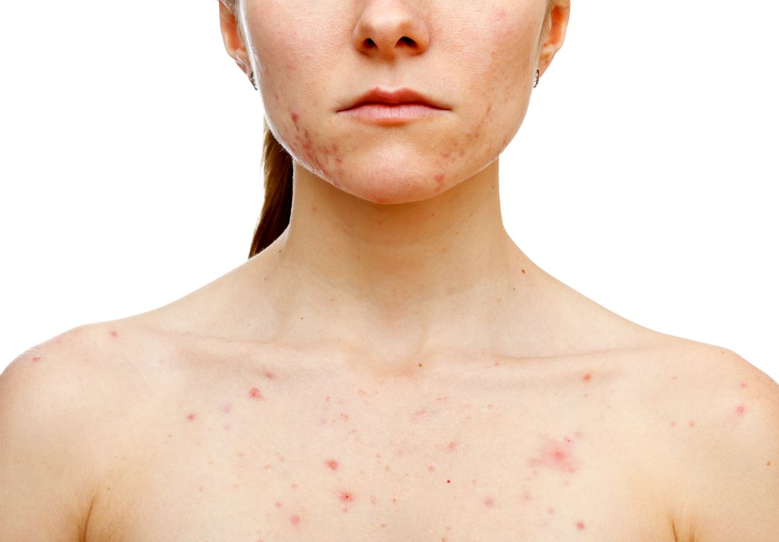 How to Get Rid of Body Acne